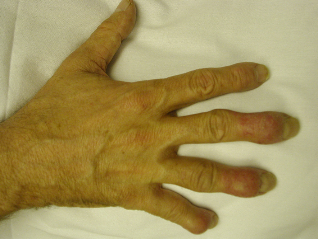Arthritic Hand : Johns Hopkins Sjögren’s Center
